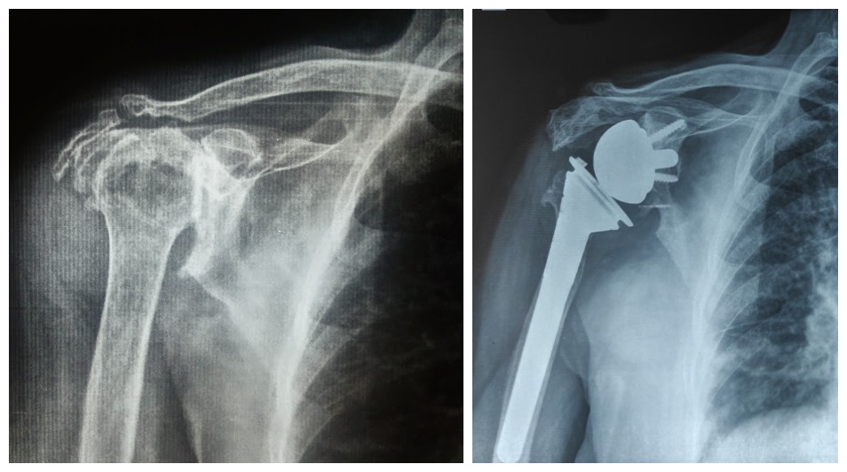 Shoulder Problems - Orthopedic Surgeon Bangalore | Jayateerth Kulkarni